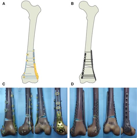 A Model Of Ao Ota Classification A3 Fracture Of Distal Femur Fixed Download Scientific