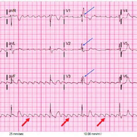 Admission Electrocardiogram Revealing Typical Atrial Flutter Red Download Scientific Diagram