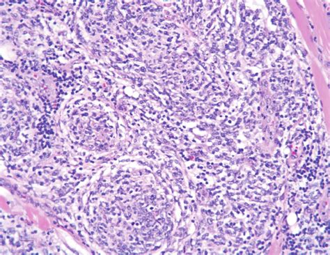 Low Power View Shows Nodular And Diffuse Pattern Of Pleomorphic Download Scientific Diagram