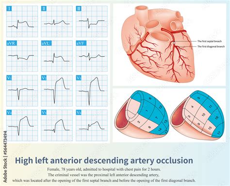Fotografija Poster The Occlusion Of The Proximal Left Anterior Descending Artery Can Cause