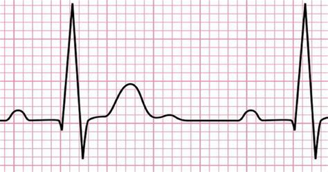 The Basics Of Ecg Interpretation Part 3 Waves Segments And Intervals