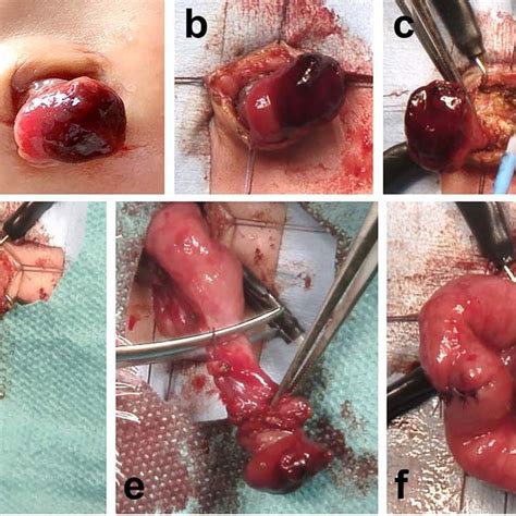 Resection Of A Patent Omphalomesenteric Duct Using An Intraumbilical