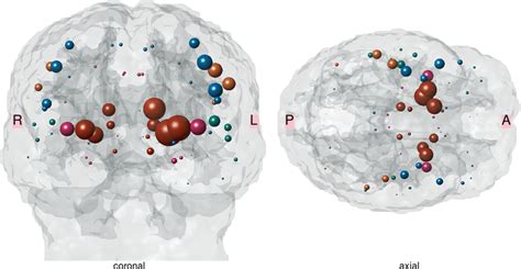Pattern And Magnitude Of Structural Disconnection Induced By Acute Download Scientific Diagram