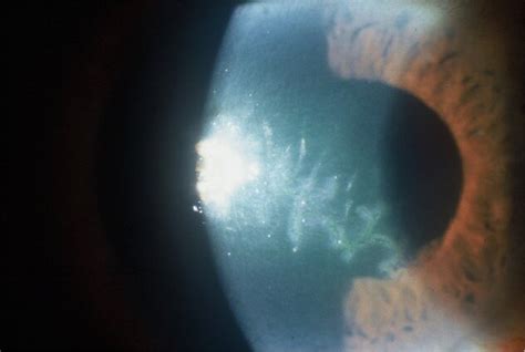 Large Epithelial Dendrite Due To Herpes Simplex Virus Download Scientific Diagram