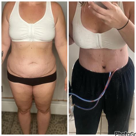 10 Days Post Op Whats Your Activity Level Rtummytucksurgery 10 Days Post Op Whats Your Activity Level Rtummytucksurgery