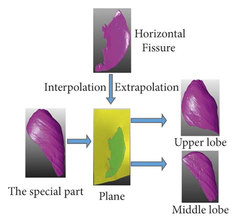 Pulmonary Lobe Separation A Right Complete Oblique Fissure Surface