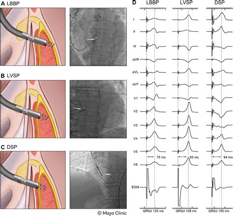Left Bundle Branch Pacing Vs Ventricular Septal Pacing For Cardiac