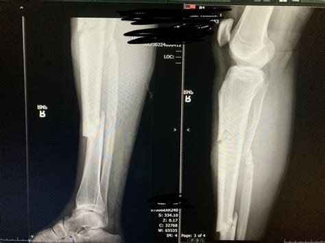 Segmental Fractures Of The Tibia R Radiology