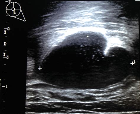 What Type Of Breast Screening Do You Need Harvard Health