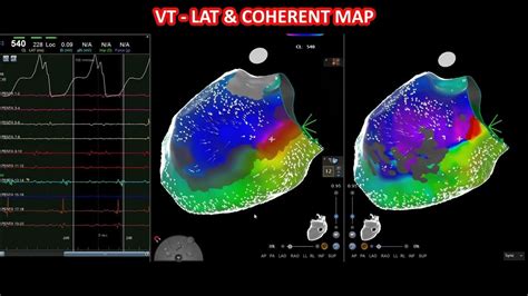 Vt Ablation Vt Block In 1 Sec Youtube