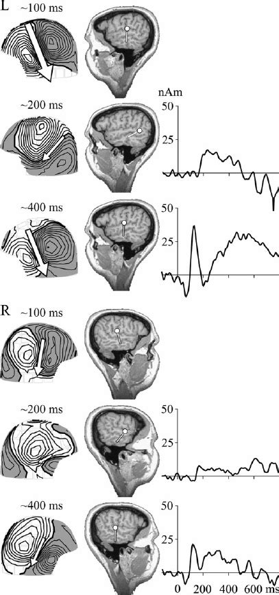 Typical Meg Field Patterns Equivalent Current Dipole Ecd Download Scientific Diagram