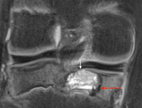 Chondroblastoma Of The Proximal Tibia Eurorad