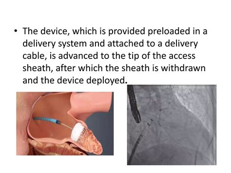 Left Atrial Appendage Closure Pptx
