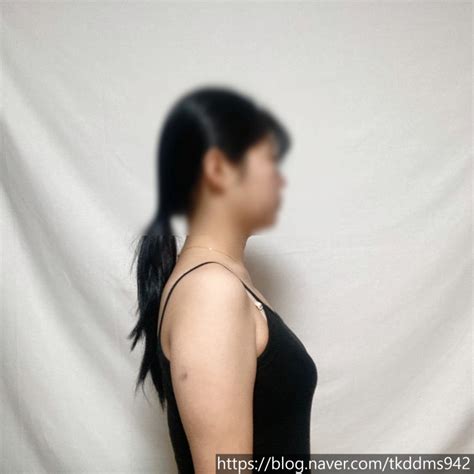 팔뚝지방분해주사가격 부담없는 1회사 시술 후기 네이버 블로그