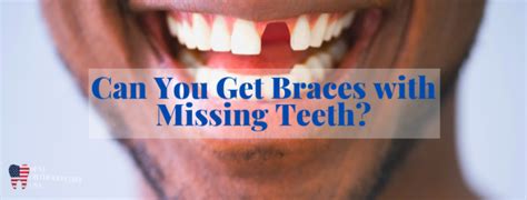 Can You Get Braces Or Invisalign With Missing Teeth
