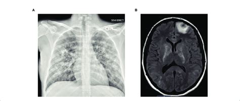 A Chest X Ray Revealing Diffuse Interstitial And Airspace Download Scientific Diagram