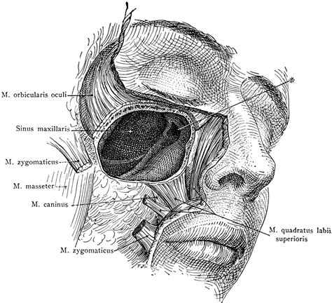 Dissection Of The Maxillary Sinus Clipart Etc