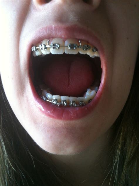 Braces Orthagnathic Surgery And The Whole Sha Bang