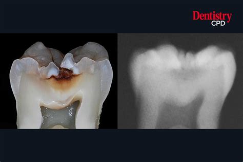 Dentistry Cpd Endodontic Access And Beyond Part One
