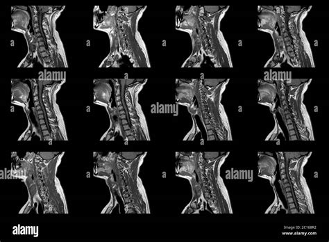 Set Of Sagittal Mri Scans Of Neck Area Of Caucasian Male With Bilateral