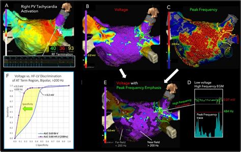 Ab 452674 1 High Frequency Electrogram Characteristics In Regions Of Low Voltage Accurately