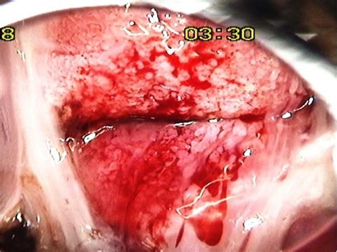 Cervical Ectropion Removal And Bleeding Gonorrhea
