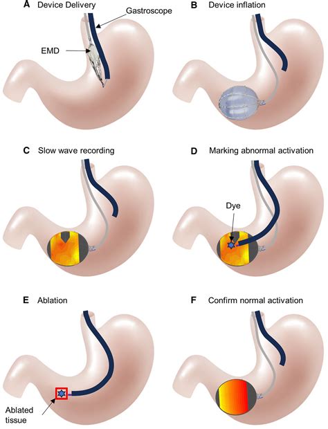 Endoscopic Mapping Of Bioelectric Slow Waves In The Gastric Antrum Device