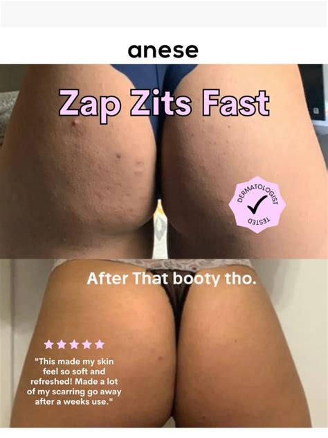 Anese Say Goodbye To Problem Pimples Milled