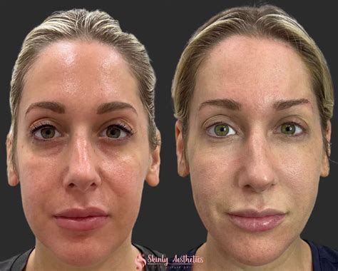Cheek Fillers Before And After Results At Skinly