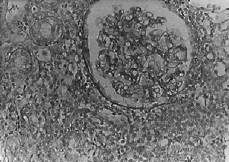 Di Ff Use Interstitial Infiltrate Mainly Consisting Of Lymphocytes And Download Scientific