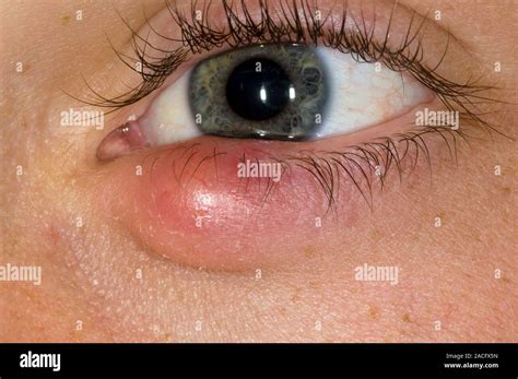 Meibomian Abscess In The Lower Eyelid Of An Adult Patient The Lump Is