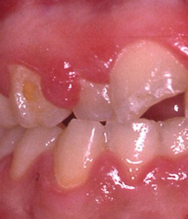 Gingival Lesions Pocket Dentistry