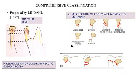Condylar Fractures And Its Managementpptx
