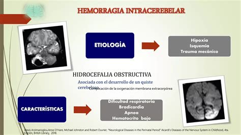 Hemorragia Intraventricular Pptx