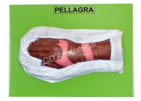 Pellagra Model