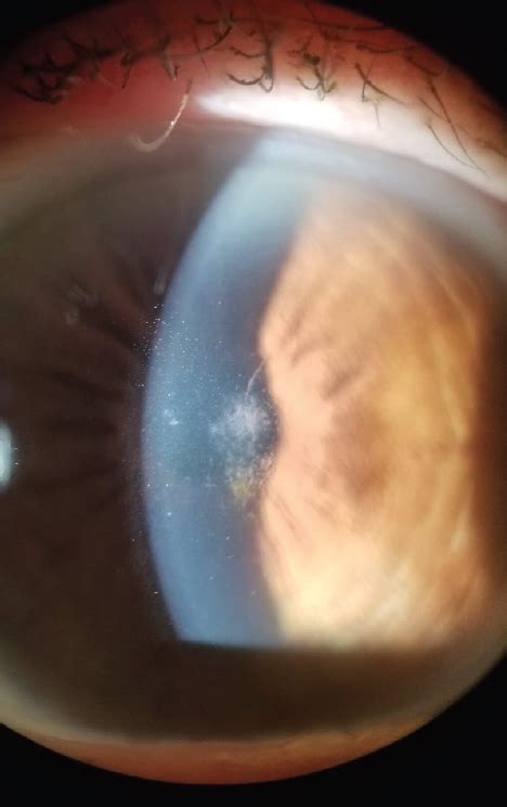 Epithelial Basement Membrane Dystrophy