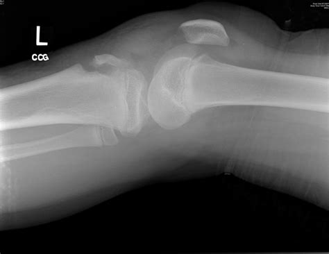 Apophysitis Dont Forget The Bubbles