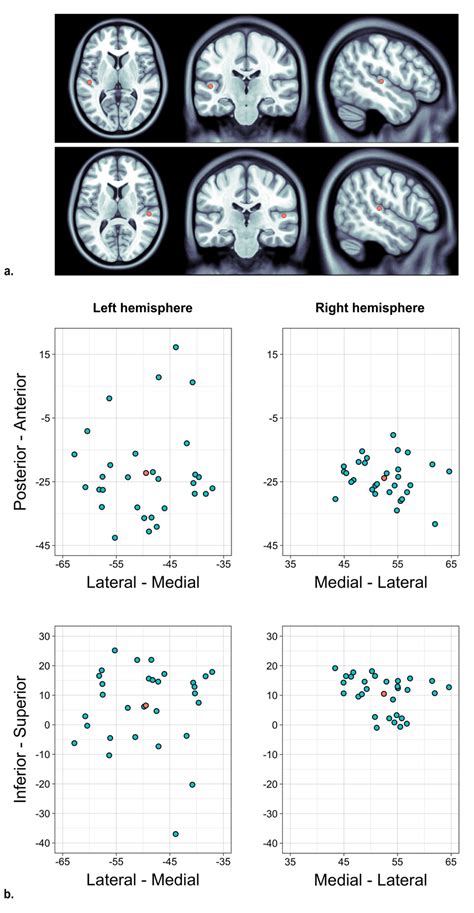 The Localization Of 40 Hz Auditory Steady State Response Assr In Mni