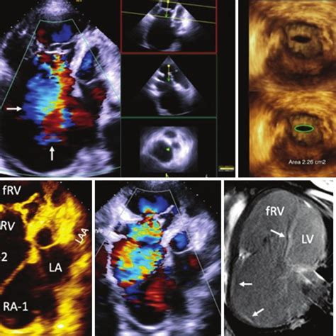 Transthoracic 2 D And 3 D Echocardiography And Cardiac Magnetic