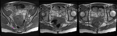 Imaging Diagnosis Of Pelvic Nerve Syndromes Magnetic Resonance