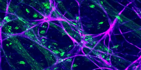 Astrocytes Try To Rescue Fellow Eyes Optic Nerve American Academy Of