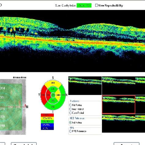 One Month After The Second Bevacizumab Treatment The Patient Had Download Scientific Diagram
