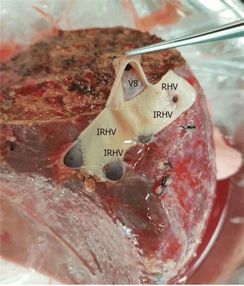The Cryopreserved Aortic Vascular Graft Patch Was Placed Between The