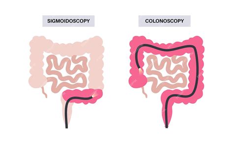 Premium Vector Colonoscopy And Sigmoidoscopy Test Examination And