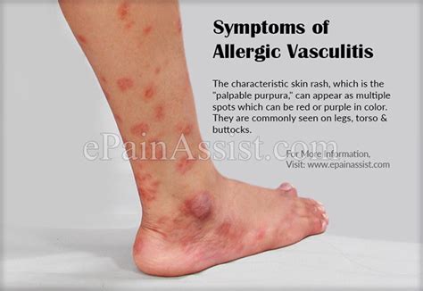 What Is Hypersensitivity Vasculitis Or Allergic Vasculitis And How Is It Treated