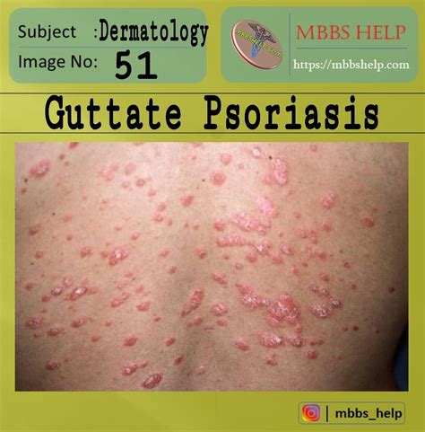 Guttate Psoriasis