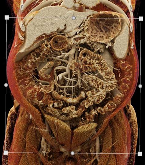 Pancreatic Cancer With Dilated Pancreatic Duct And Incidental Gist