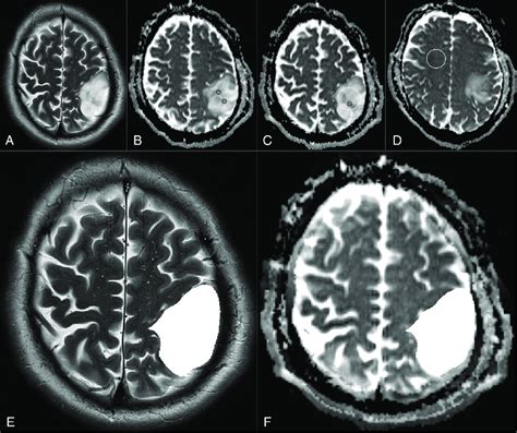 An Example Of Regional And Volumetric ADC Measurements In A Patient
