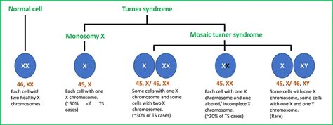 Turner Syndrome Diagram