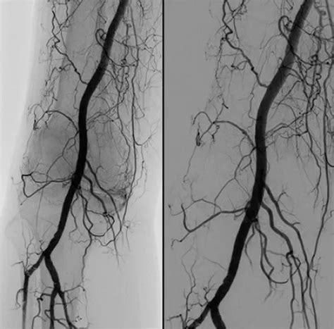Geniculate Artery Embolization Gae A Minimally Invasive Option To